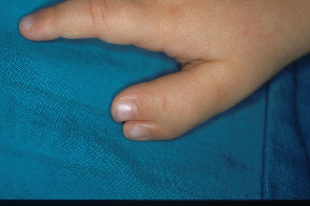 Polidactilias - Dr. César Silva