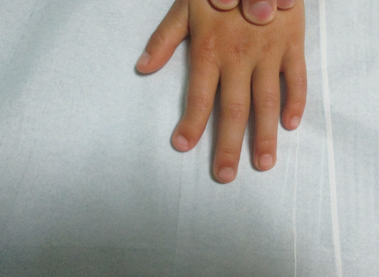 CLINODACTILIA - Dr. César Silva